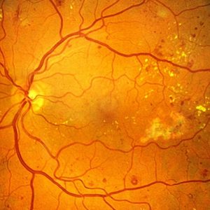Stages of Diabetic Retinopathy - Patient & Caregiver